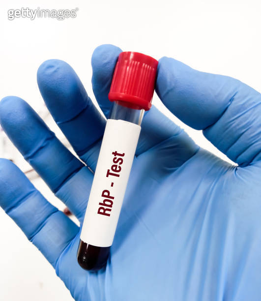 Blood sample for Retinol Binding Protein (RbP) testing which is used to ...