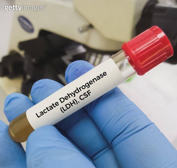 CSF sample for LDH (lactate dehydrogenase) test. (1829455307) - 게티이미지뱅크