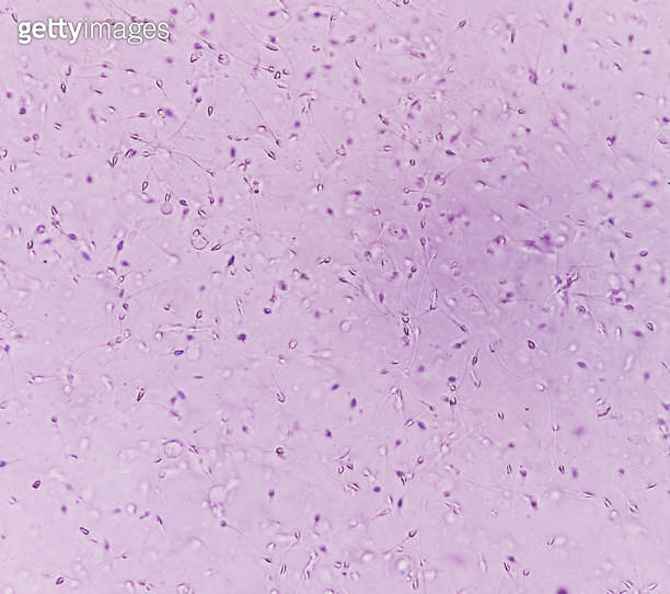 Semen analysis. Normozoospermia analyzed by microscope. Normal sperm ...
