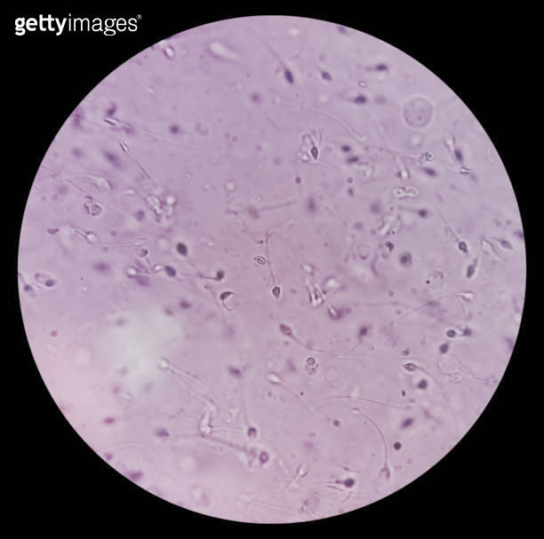 Semen analysis. Normozoospermia analyzed by microscope. Normal sperm ...