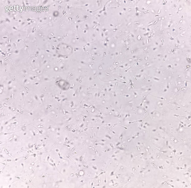 Semen analysis. Normozoospermia analyzed by microscope. Normal sperm ...