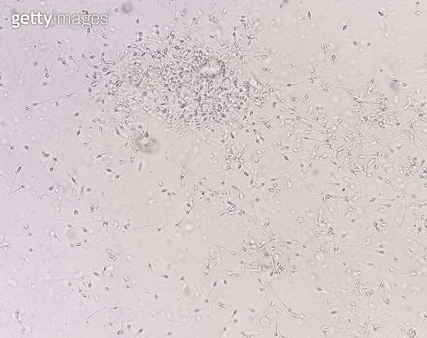 Semen analysis. Normozoospermia analyzed by microscope. Normal sperm ...