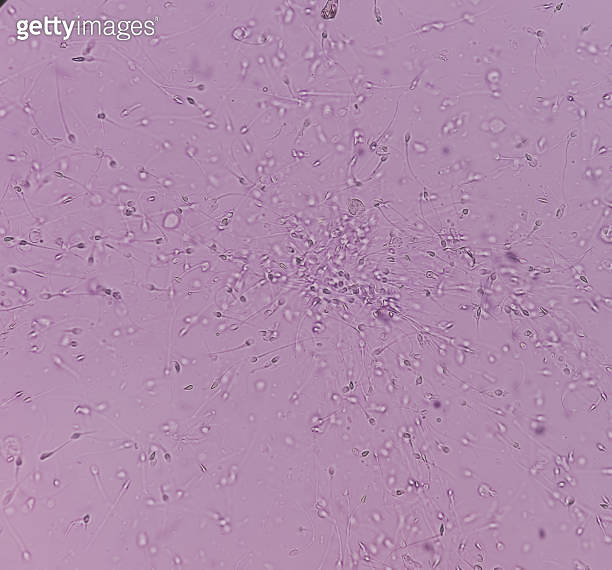 Semen analysis. Normozoospermia analyzed by microscope. Normal sperm ...