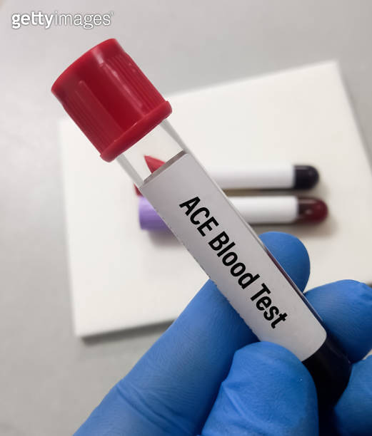 Blood test sample for Angiotensin-converting enzyme (ACE) test. 이미지 ...