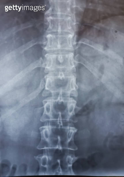 x ray image of human dorsal lumber spine ap view. Early degenerative ...