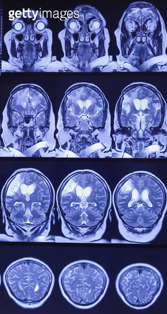 MRI (Magnetic Resonance Imaging) of brain and MRA. Brain showing ...