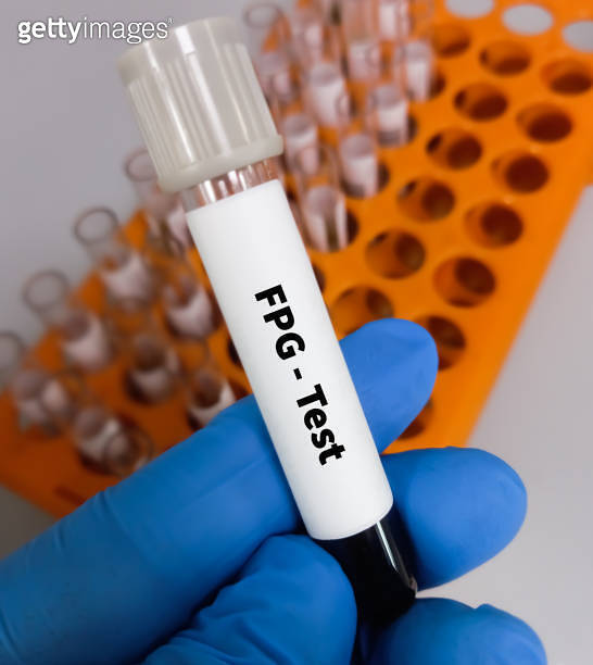 Scientist hold a sample for Glucose test, FPG test to diagnosis of ...