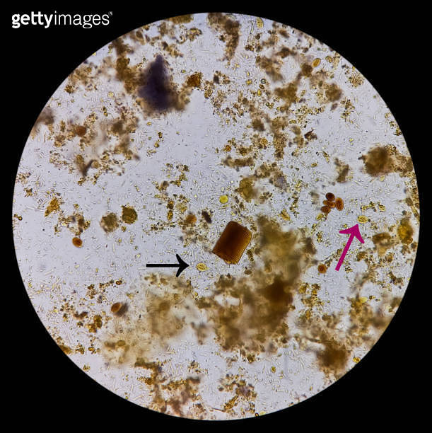 Giardia lamblia cysts and Trophozoite form, muscle fiber in stool ...