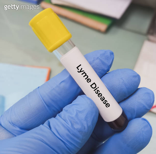 Blood sample for Lyme disease testing at laboratory. (1798734421) - 게티이미지뱅크