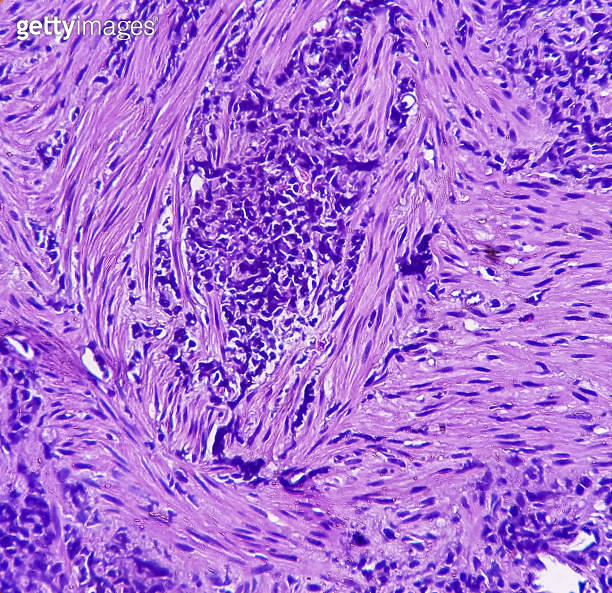 Sigmoid colon (colonoscopic biopsy): Chronic nonspecific colitis. Show ...