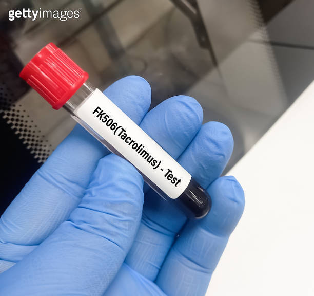 Blood sample for FK506 (Tacrolimus) level test, immunosuppressive drug ...