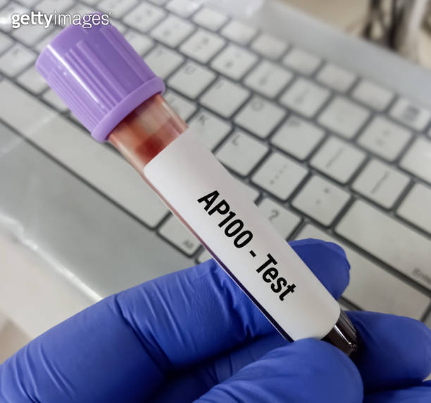 Blood sample for AP100 test, total hemolytic complement. to measurement ...