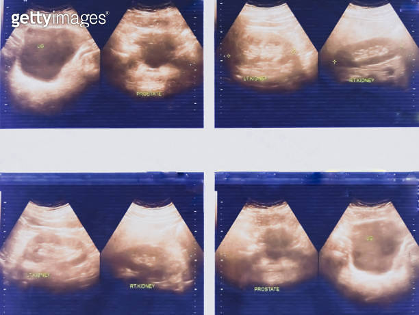 USG image of KUB (Kidneys, Ureters and Bladder). Normal study. 이미지 ...
