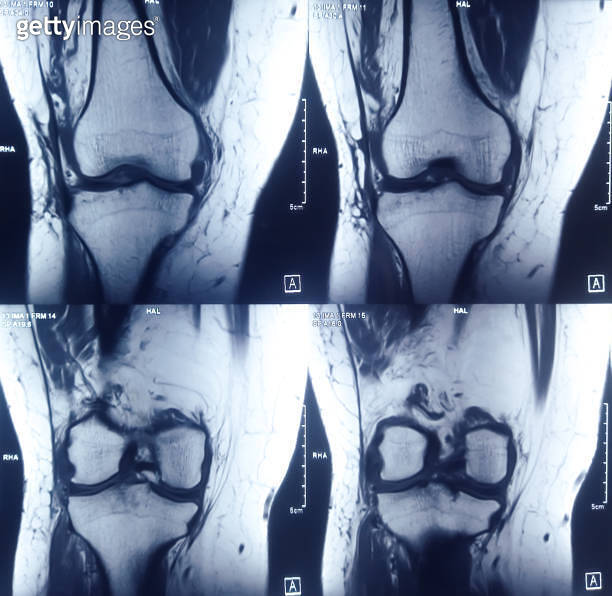 Knee joint x-ray or CT scan. Doctor pointed on area of knee joint ...