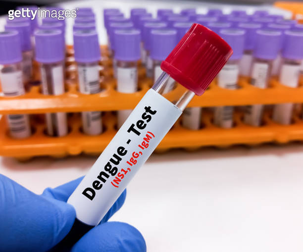 Close view of technician hand hold blood sample for dengue virus (IgG ...