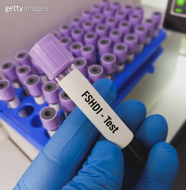Blood sample for FSHD1 Southern Blot Test, deletions on chromosome 4q35 ...