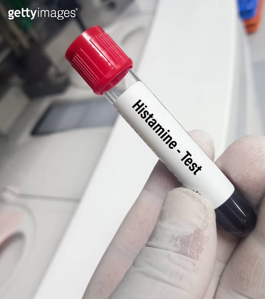 Blood sample for Histamine blood test, to diagnosis of anaphylaxis ...