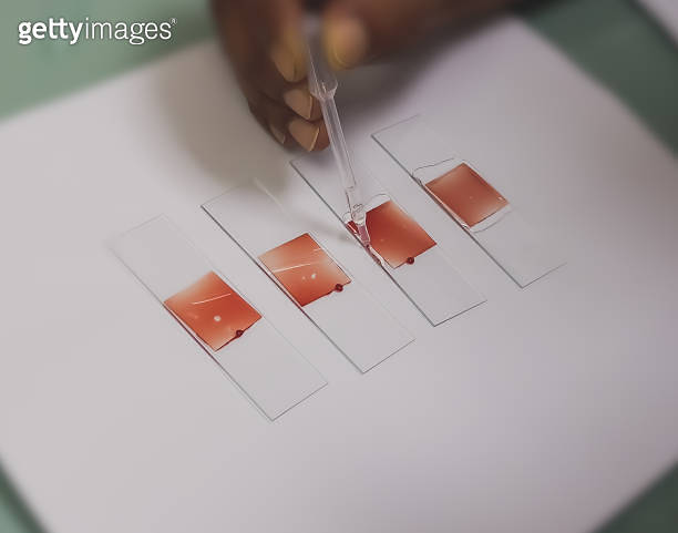 Technician preparing blood smear for sickling test to diagnosed Sickle ...