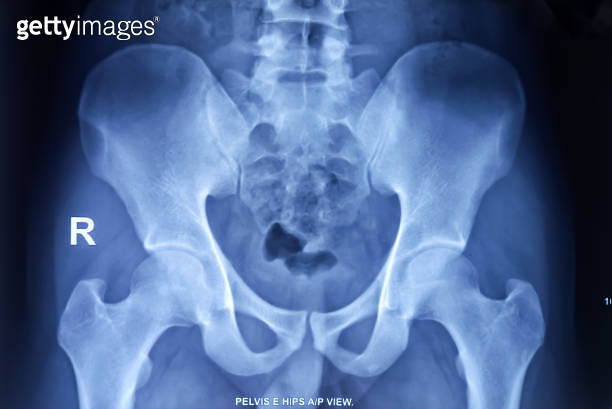 Pelvis x-ray. Film X-ray of Pelvis, hip and SI joint are normal, Normal ...