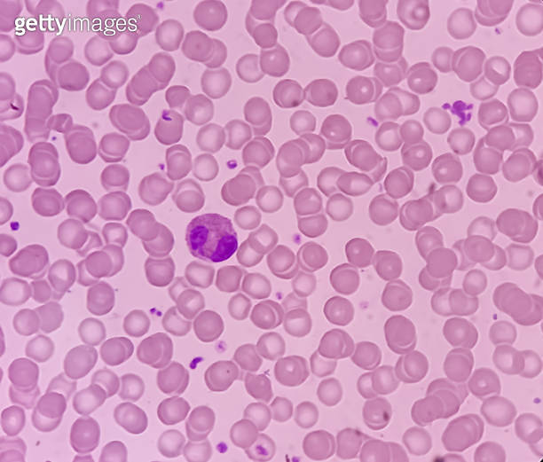 Photomicrograph of hematological slide showing RBC, WBC (Eosinophil ...