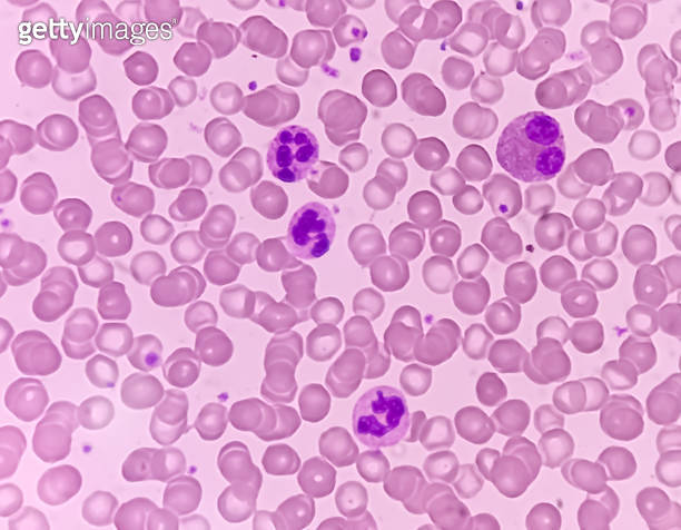 Photomicrograph of hematological slide showing RBC, WBC (Neutrophils ...