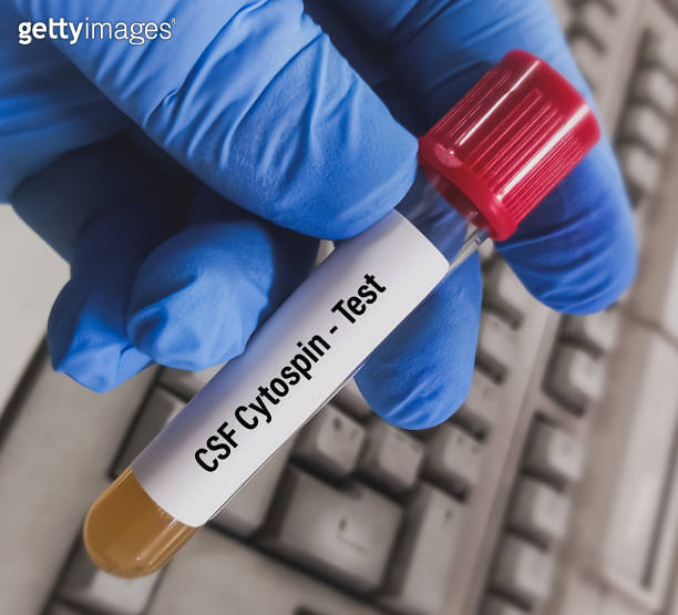 Cytospin test. Cerebrospinal fluid (CSF) cytology testing. It was ...