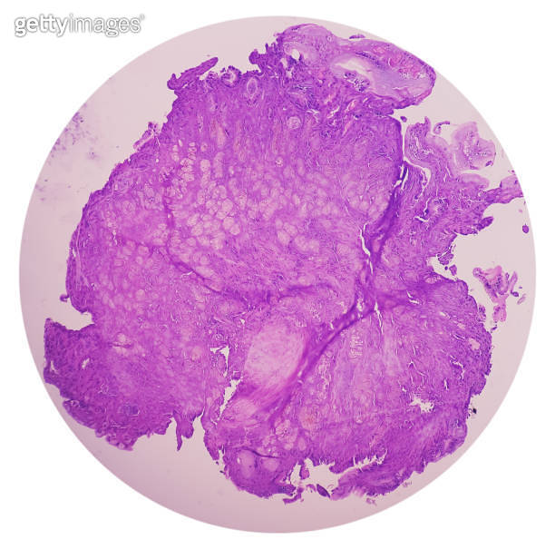 Tissue from antrum of stomach (endoscopic biopsy): Chronic nonspecific ...