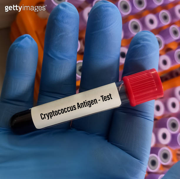 Blood sample for Cryptococcus Antigen test to diagnosis of cryptococcal ...