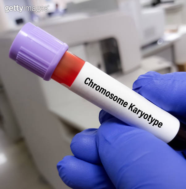 Blood sample for Chromosomal analysis karyotype testing with patient ...