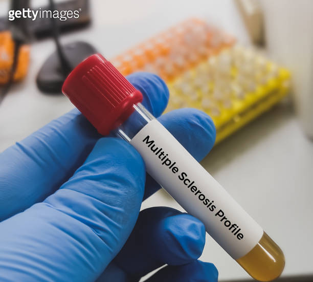 CSF sample for Multiple Sclerosis testing. Multiple Sclerosis disease ...