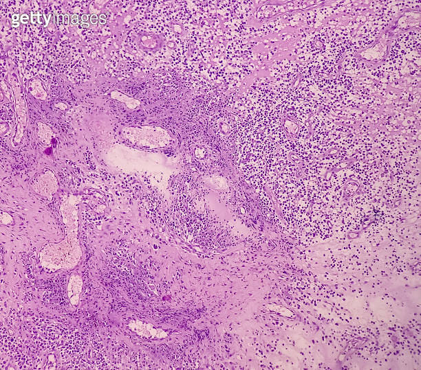 Ear (biopsy): Microphotograph of Granulation tissues, show dense ...