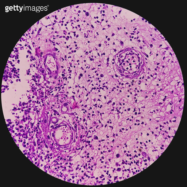 Ear (biopsy): Microphotograph of Granulation tissues, show dense ...