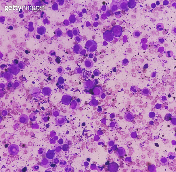 Acute leukemia, ALL(Acute lymphoblastic leukemia), peripheral blood ...