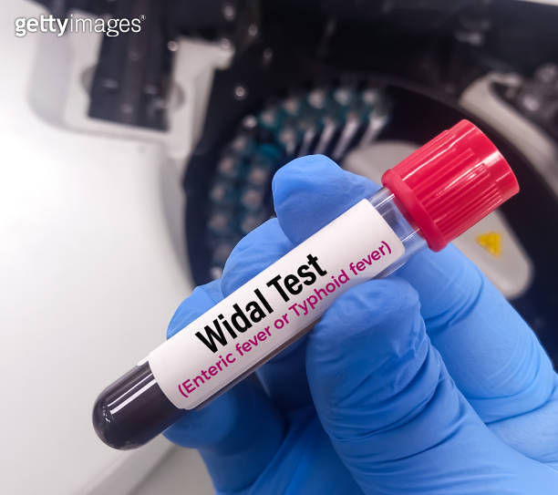 Blood sample for Widal test, to diagnosis of salmonellosis (enteric ...