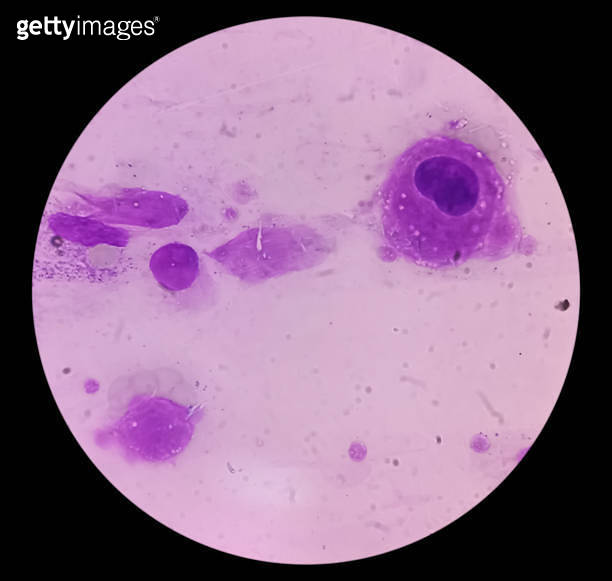Chronic myeloid leukemia (CML) in accelerated phase also known as ...