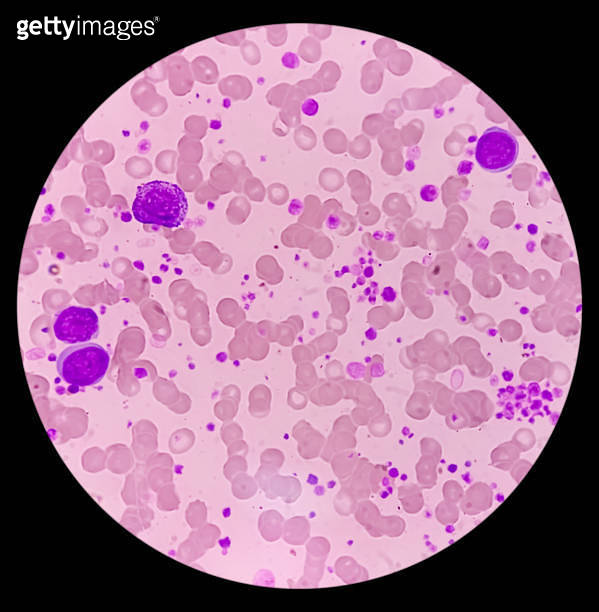 Chronic myeloid leukemia (CML) in accelerated phase also known as ...