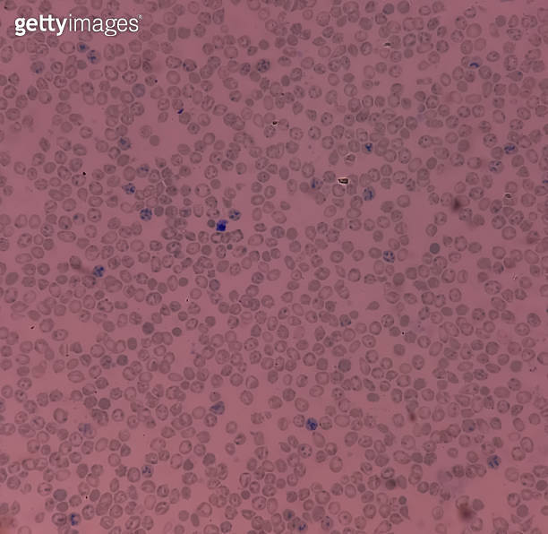 Close view of Reticulocyte count under microscope, 40x. methylene blue ...