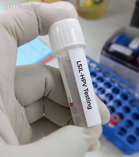 Testing tube with vaginal fluid sample for HPV DNA test, Human ...
