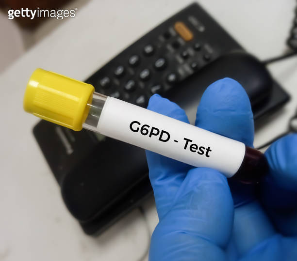 Blood sample for G6PD(glucose-6-phosphate dehydrogenase) test, helps ...