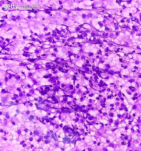 Metastatic plasmacytoma, metastatic undifferentiated sarcoma. Plasma ...