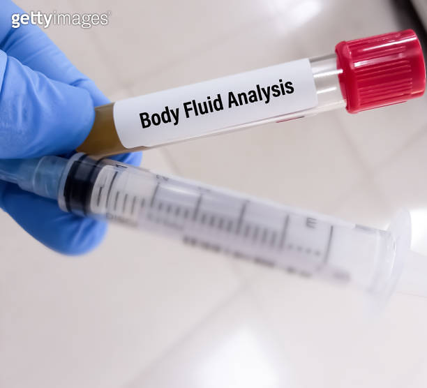 Hand holds Human body fluid sample and syringe for malignant cells ...