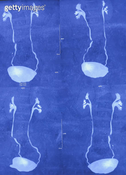 CT (computerized tomography) Urogram, used to evaluate the urinary ...