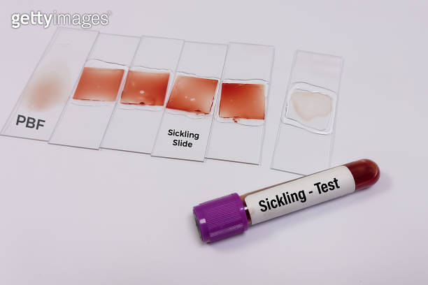 Technician preparing blood smear and blood sample for sickling test to ...