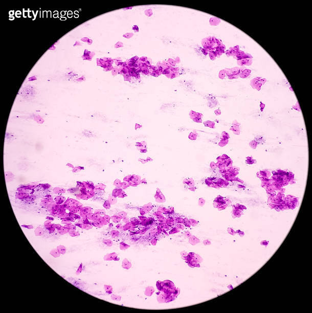 Pap's smear. Microscopic examination of pap smear showing inflammatory ...
