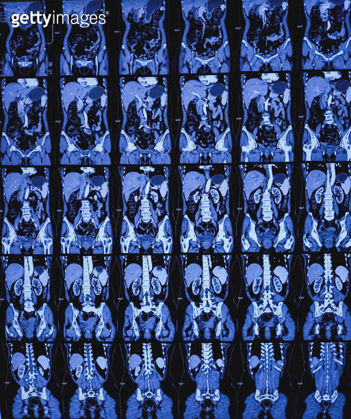 CT (computerized tomography) Urogram, used to evaluate the urinary ...