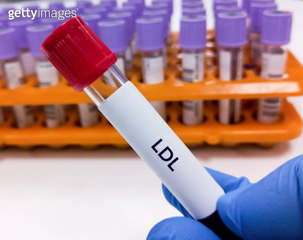 Blood sample for LDL (Low density lipoprotein) test, helps assess the ...