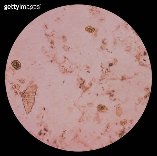 Giardia lamblia cysts and Trophozoite form, muscle fiber in stool ...