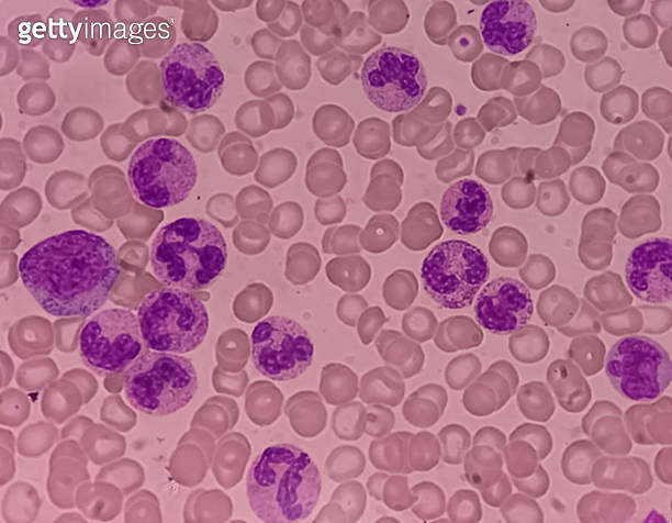 Blood cancer. Chronic myeloid leukemia(CML) with Thrombocytopenia ...