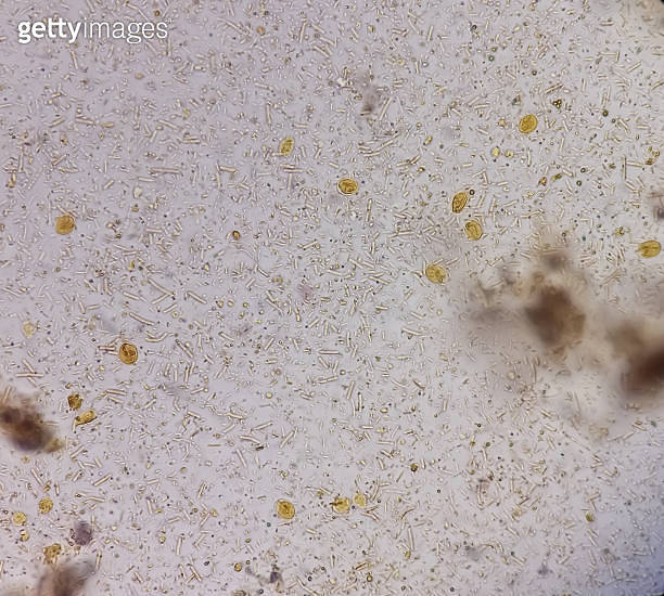 Giardia lamblia cysts and Trophozoite form, muscle fiber in stool ...