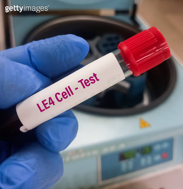 Scientist hold blood test sample tube for LE-4 cells test, lupus ...